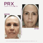PRX DERM PERFECTION | Skin Rejuvenation by Edina Skin Care
